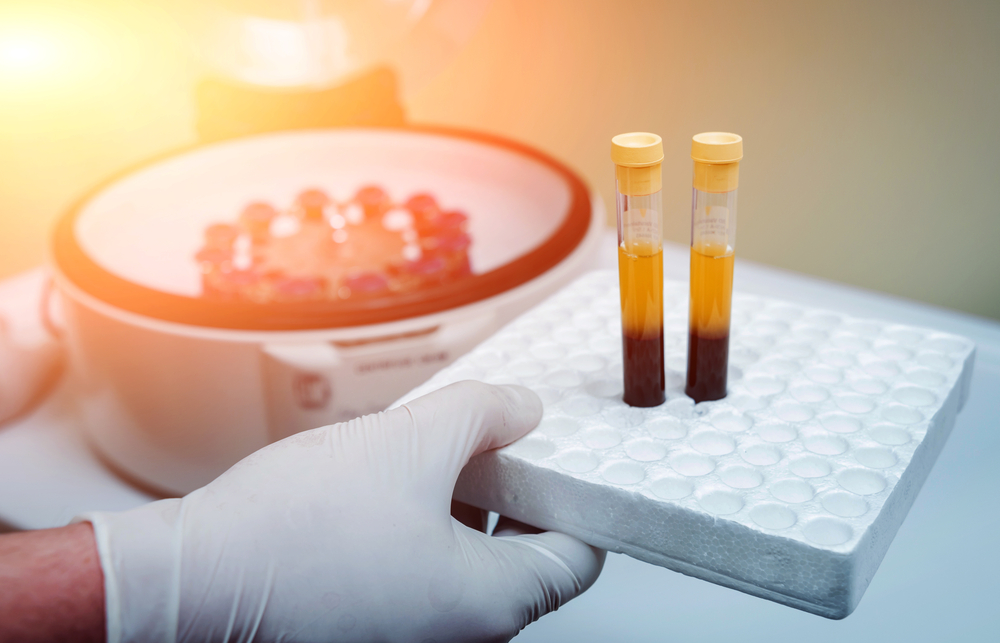 Platelet-rich,Plasma,Preparation.,Tube,With,Blood,In,Hands.,Centrifuge ...